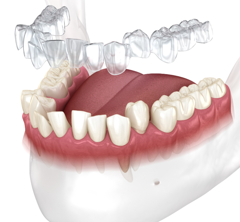 Can Invisalign close gaps between teeth? | Comfort Dental Weymouth MA ...