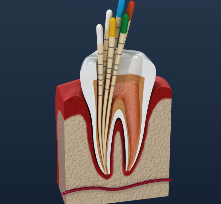 Abscess After Root Canal – Comfort Dental Weymouth MA, South Shore ...