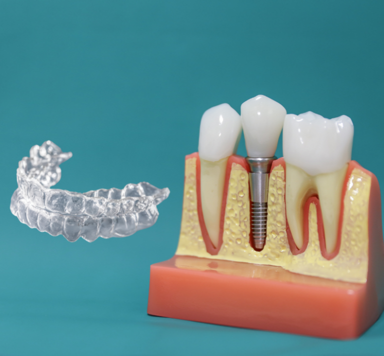 Can Invisalign Work With Dental Implants? – Comfort Dental Weymouth MA ...