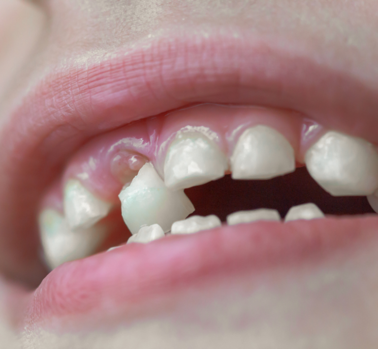 Emergency Dentist For A Tooth Knocked Out In An Accident – Comfort ...