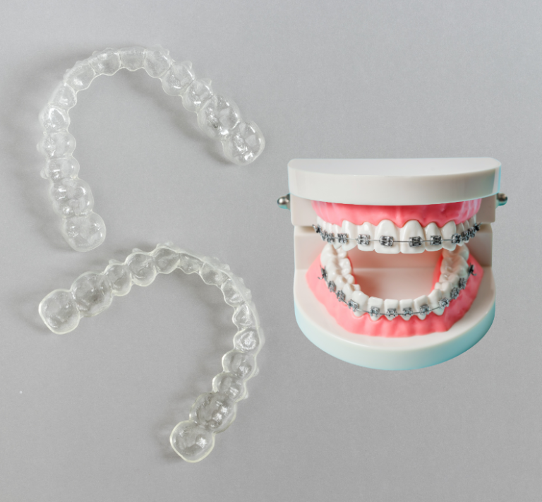 How Does Invisalign Compare To Metal Braces In Cost? – Comfort Dental ...
