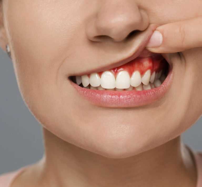 Tooth Abscess Treatment Emergency Dentist – Comfort Dental Weymouth MA ...