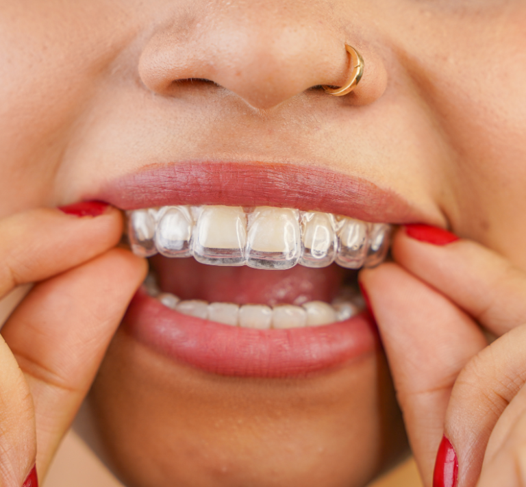Will Invisalign Work If I Have Missing Teeth? – Comfort Dental Weymouth ...